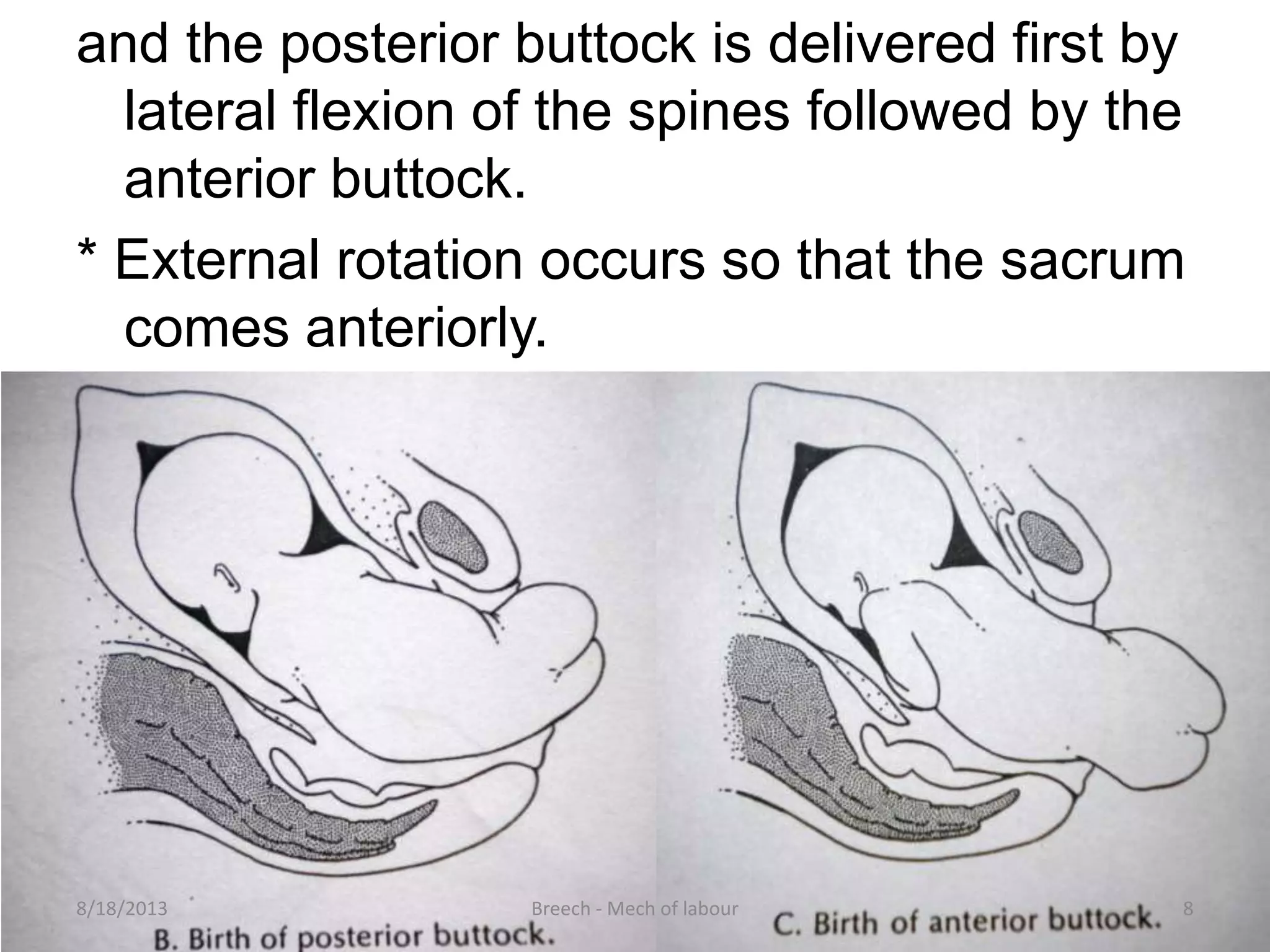 Breech mech of labour | PPTX