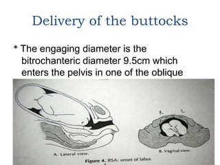 Breech mech of labour | PPTX