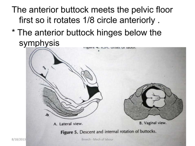 Breech mech of labour | PPTX | Pregnancy | Reproductive Health