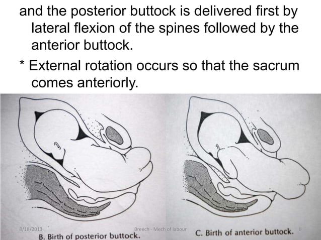 Breech mech of labour | PPTX | Pregnancy | Reproductive Health