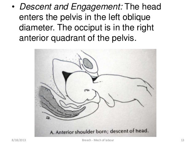 Breech mech of labour