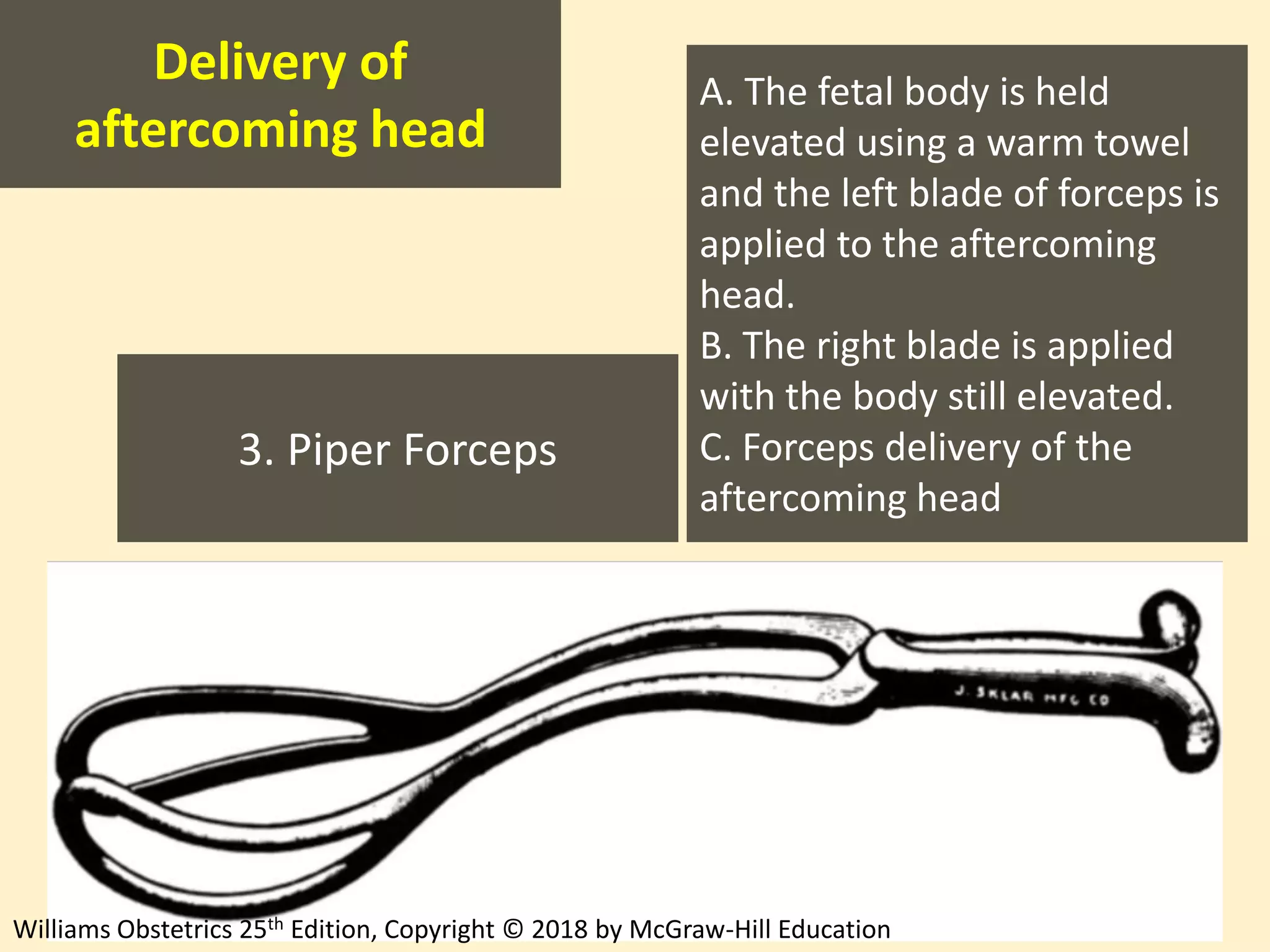 Breech Delivery | PPTX