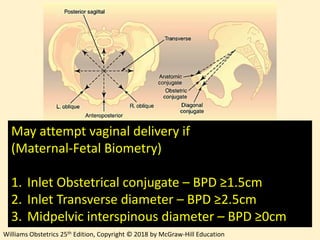 Breech Delivery | PPTX