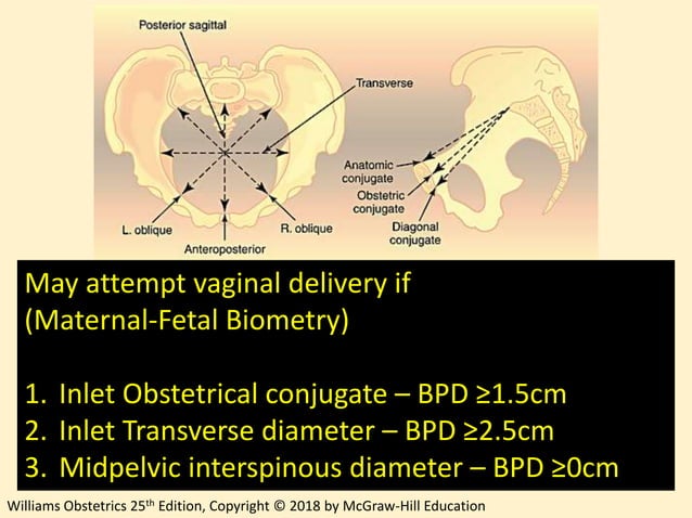 Breech Delivery | PPT