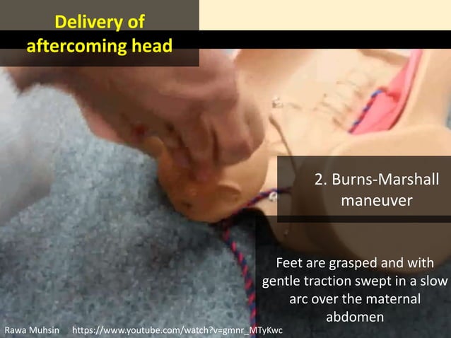 Breech Delivery | PPTX | Pregnancy | Reproductive Health