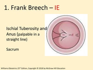 Breech Delivery | PPTX