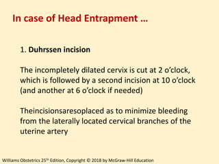 Breech Delivery | PPT