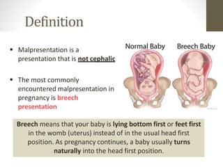 Breech presentation | PPTX