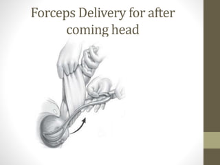 Breech presentation | PPTX