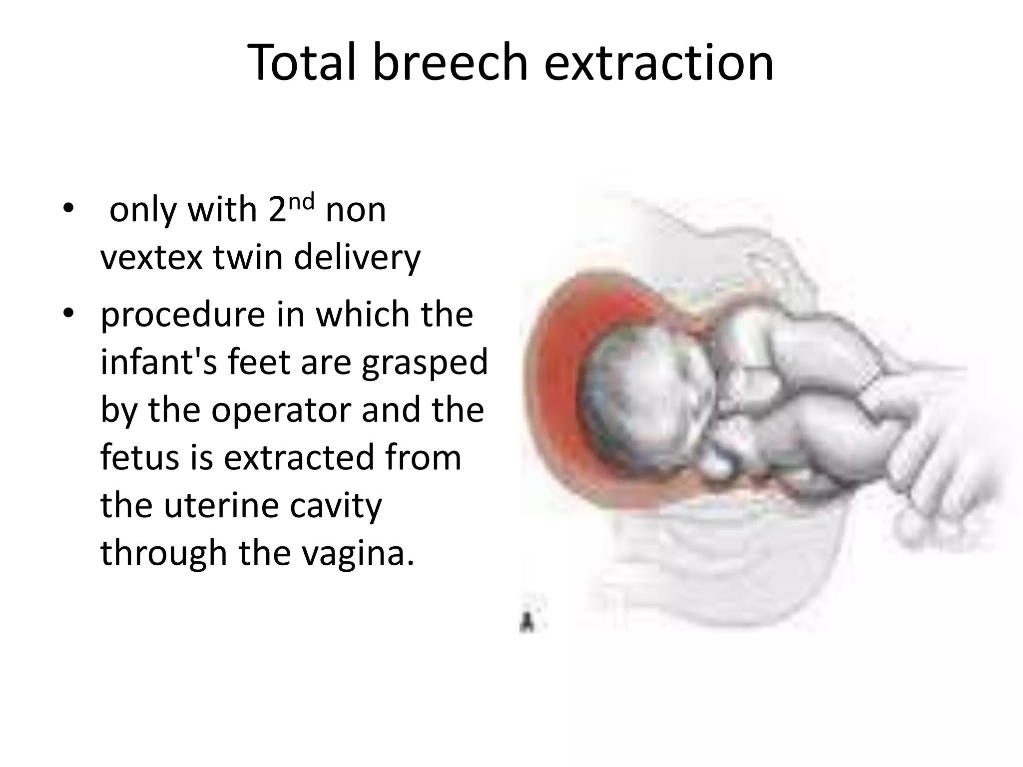breech-presentation.ppt