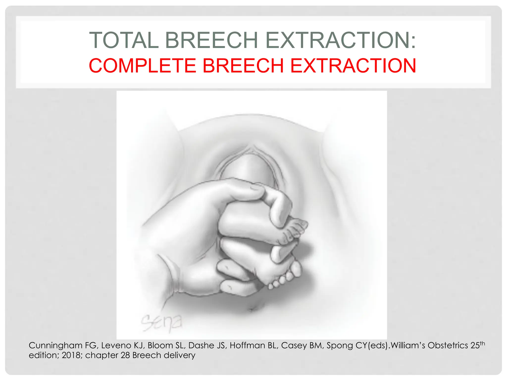 Steps in Partial & Complete Breech Delviery | PDF