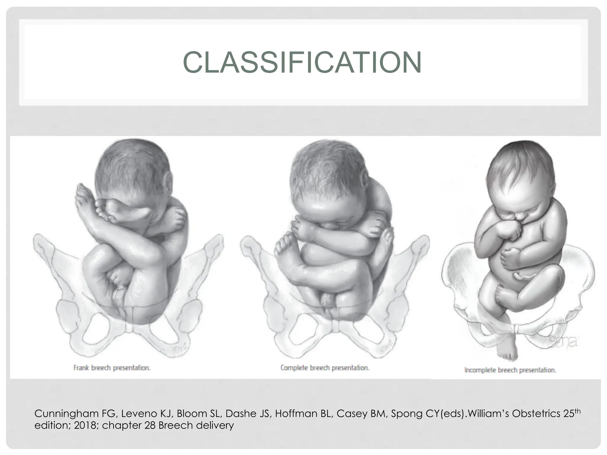 Steps in Partial & Complete Breech Delviery | PPT