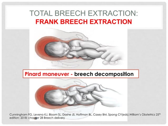 Steps in Partial & Complete Breech Delviery | PPT