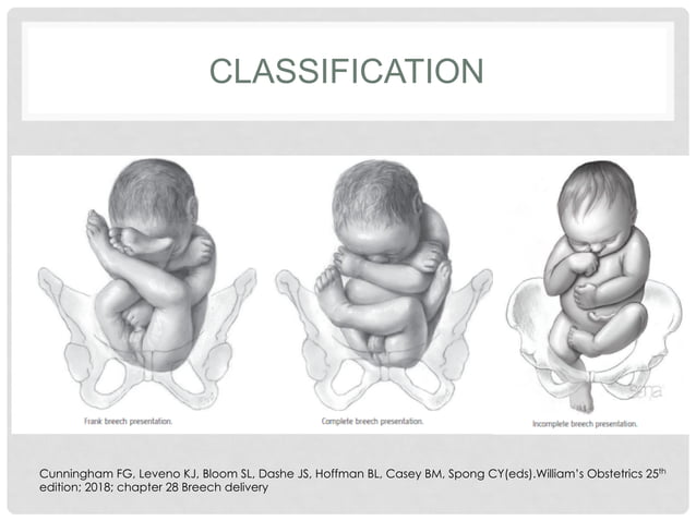 Steps in Partial & Complete Breech Delviery | PPT