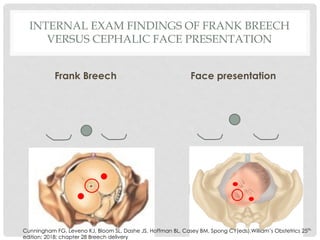 Steps in Partial & Complete Breech Delviery | PDF
