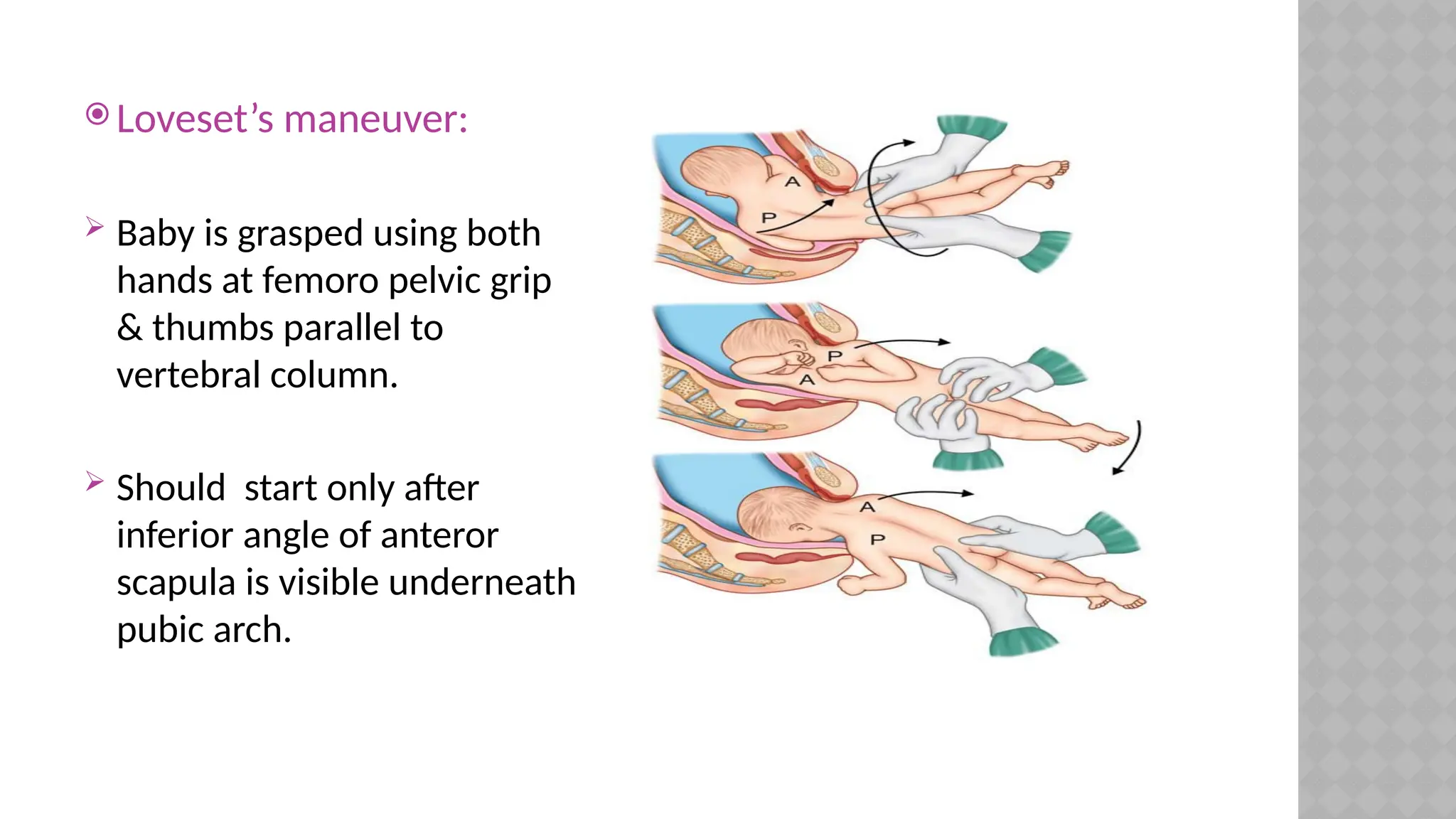 Breech presentation obstetrics .pptx