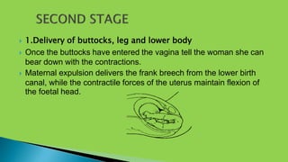 BREECH DELIVERY.pptx