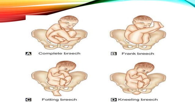 Breech delivery | PPTX | Pregnancy | Reproductive Health