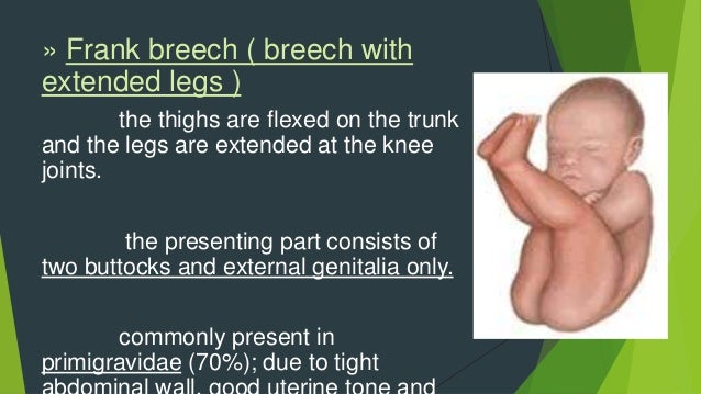 Breech presentation