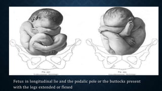 breechpresentation-160811085312.pptx