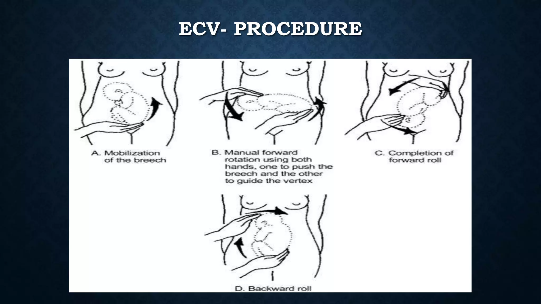 Breech presentation | PPTX