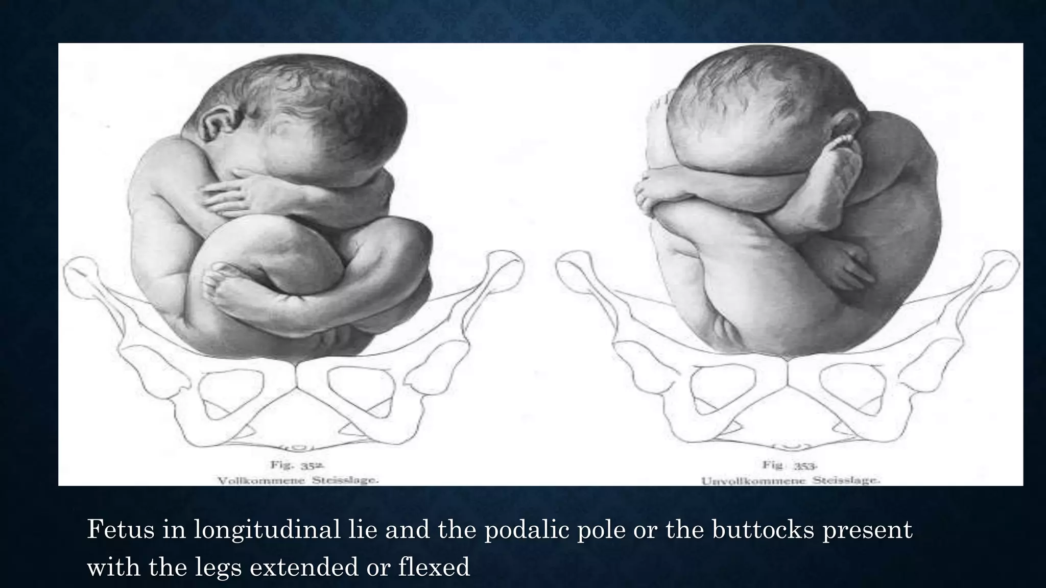 Breech presentation | PPTX
