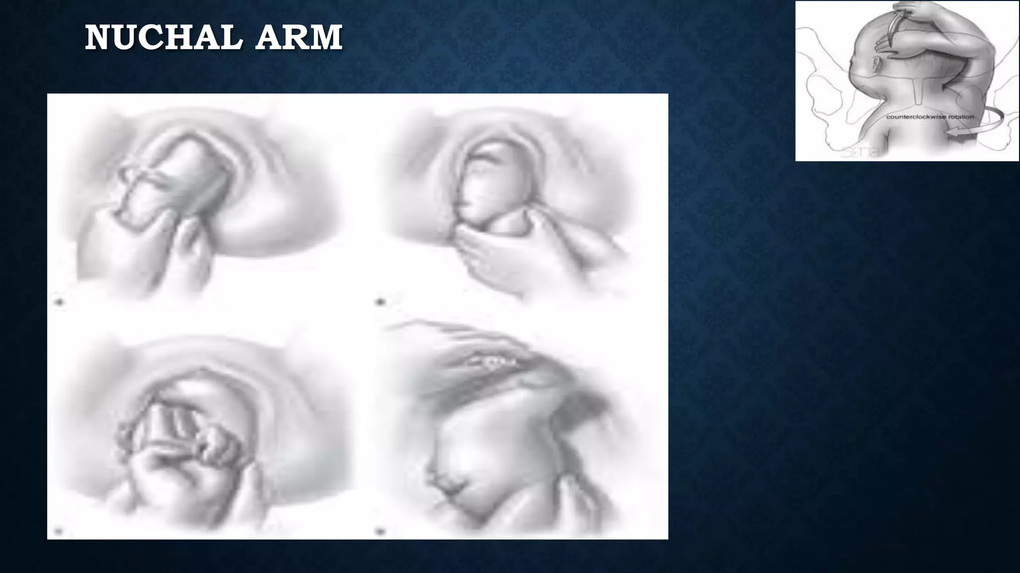 Breech presentation | PPTX