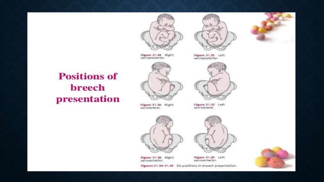Breech presentation | PPTX | Pregnancy | Reproductive Health