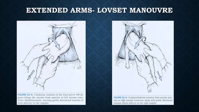 Breech presentation | PPTX | Pregnancy | Reproductive Health