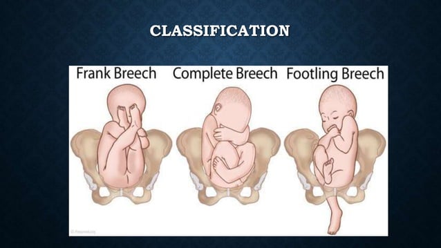 Breech presentation | PPTX | Pregnancy | Reproductive Health