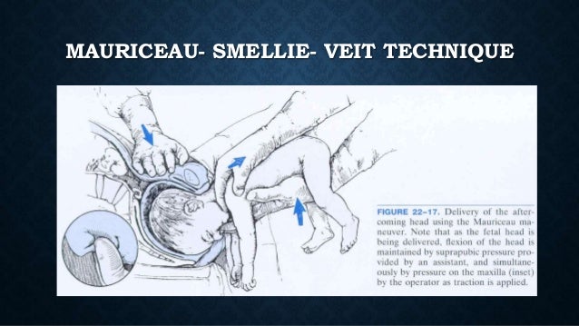 Breech presentation