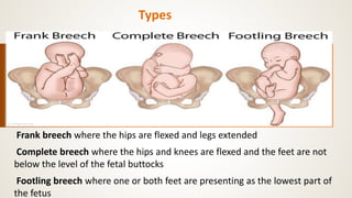 Breech presentation | PPTX