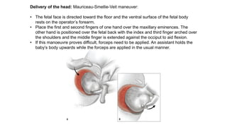 Breech presentation | PPTX