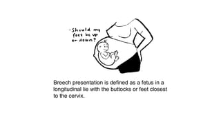 Breech presentation | PPTX