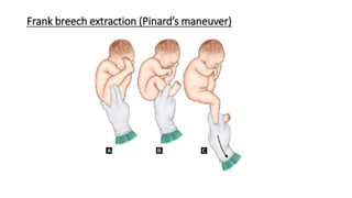 Breech presentation | PPT