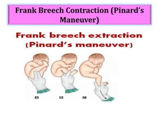 BREECH PRESENTATION | PPTX