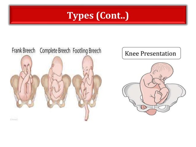 BREECH PRESENTATION | PPT