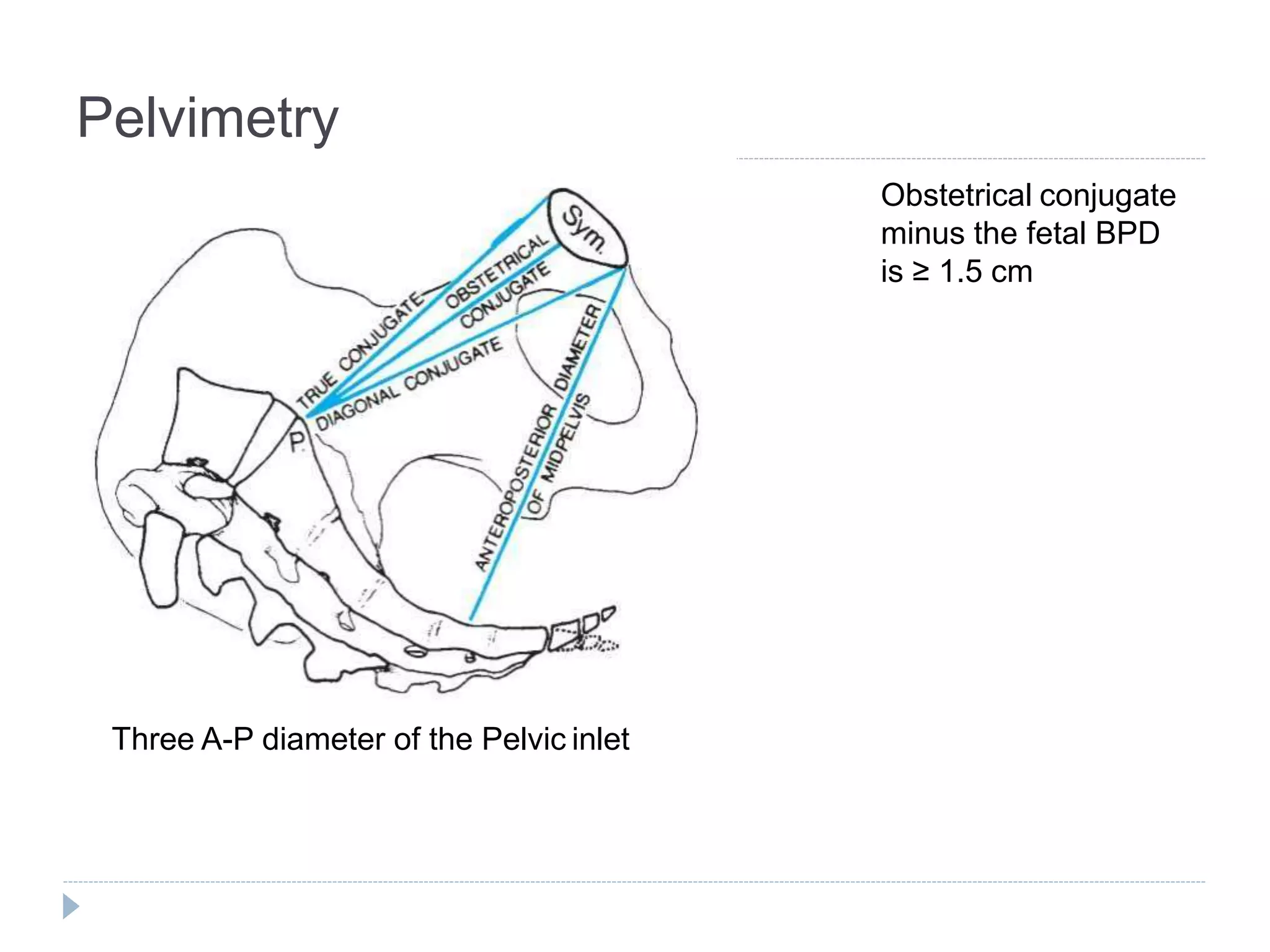 breech presentation.pptx
