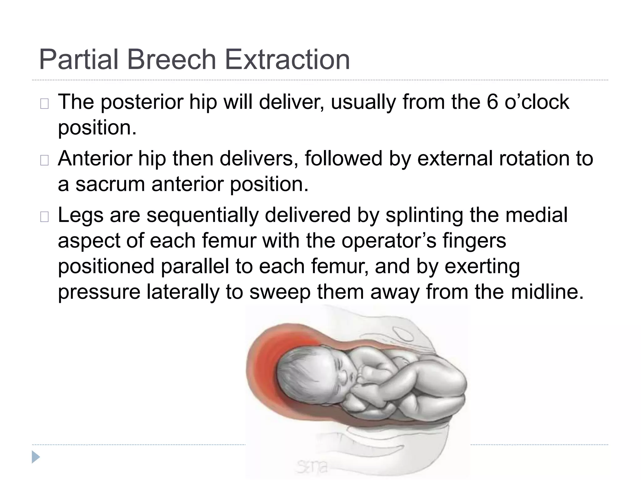 breech presentation.pptx