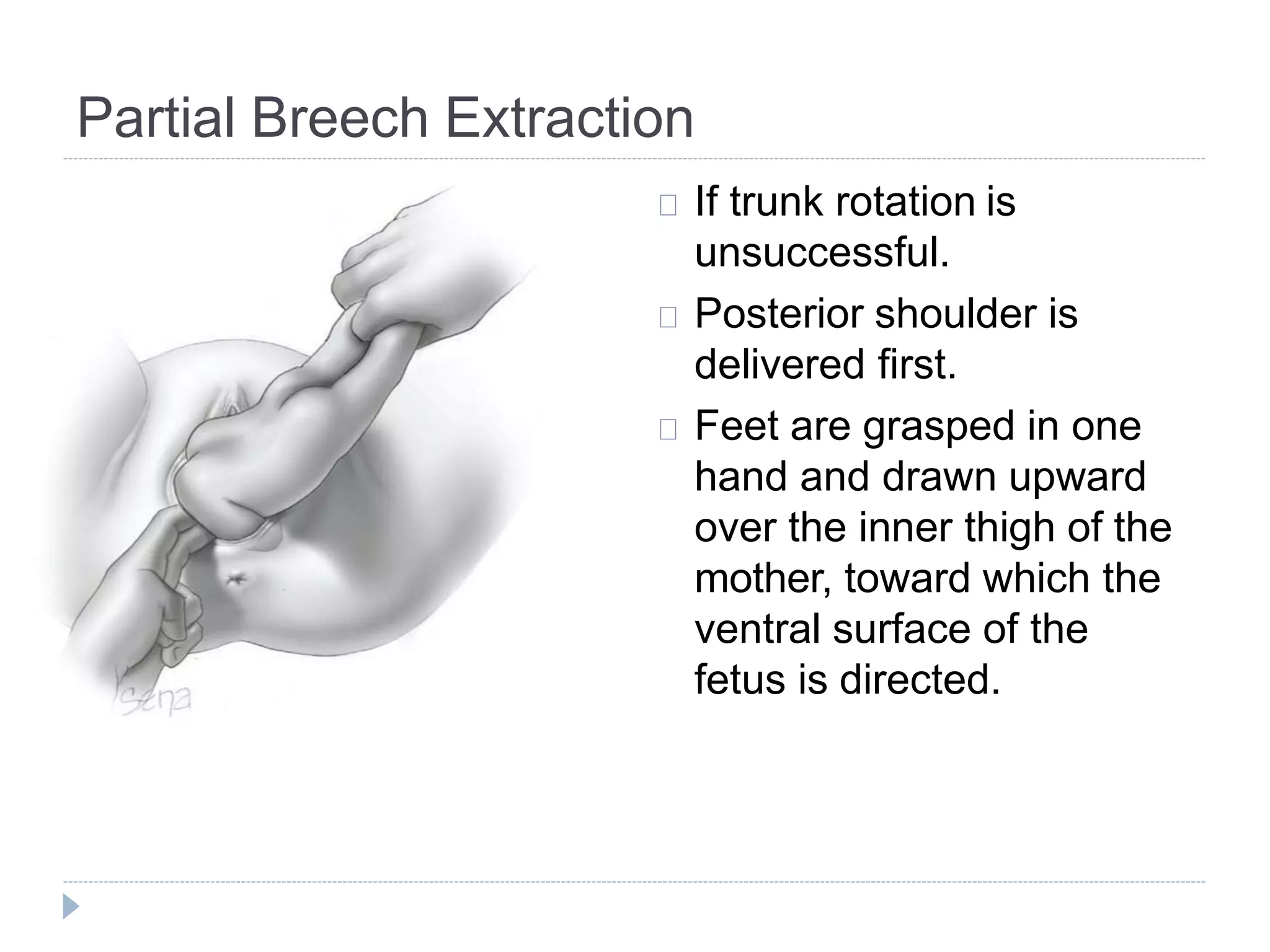 breech presentation.pptx | Pregnancy | Reproductive Health