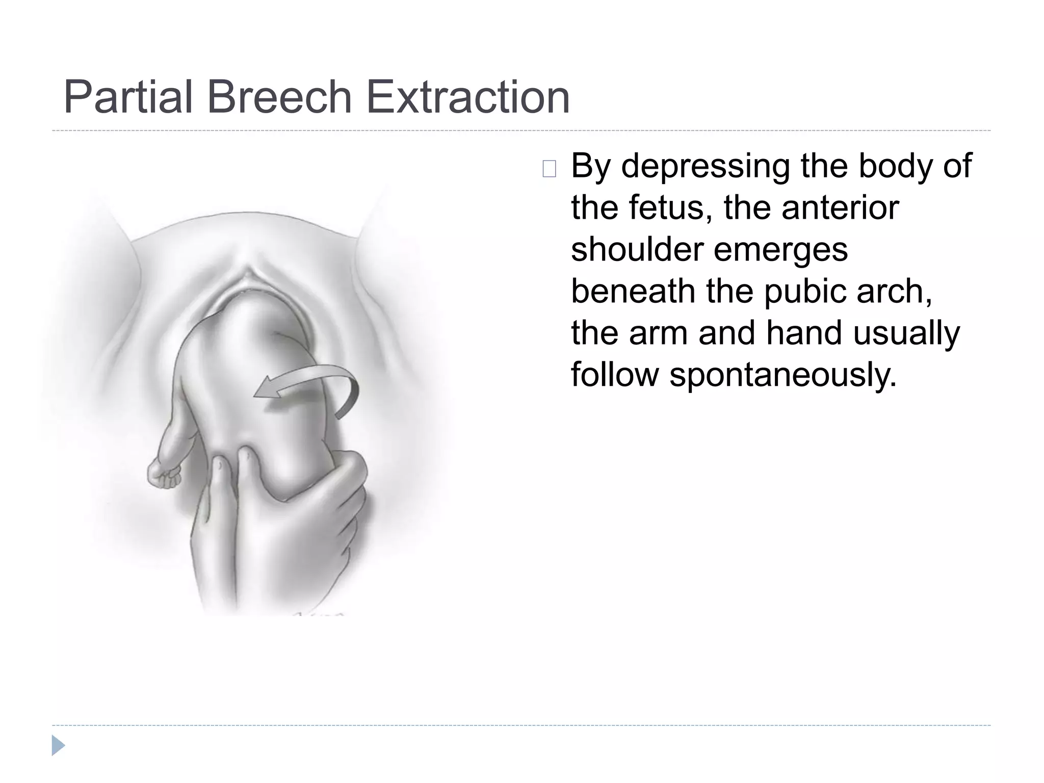breech presentation.pptx