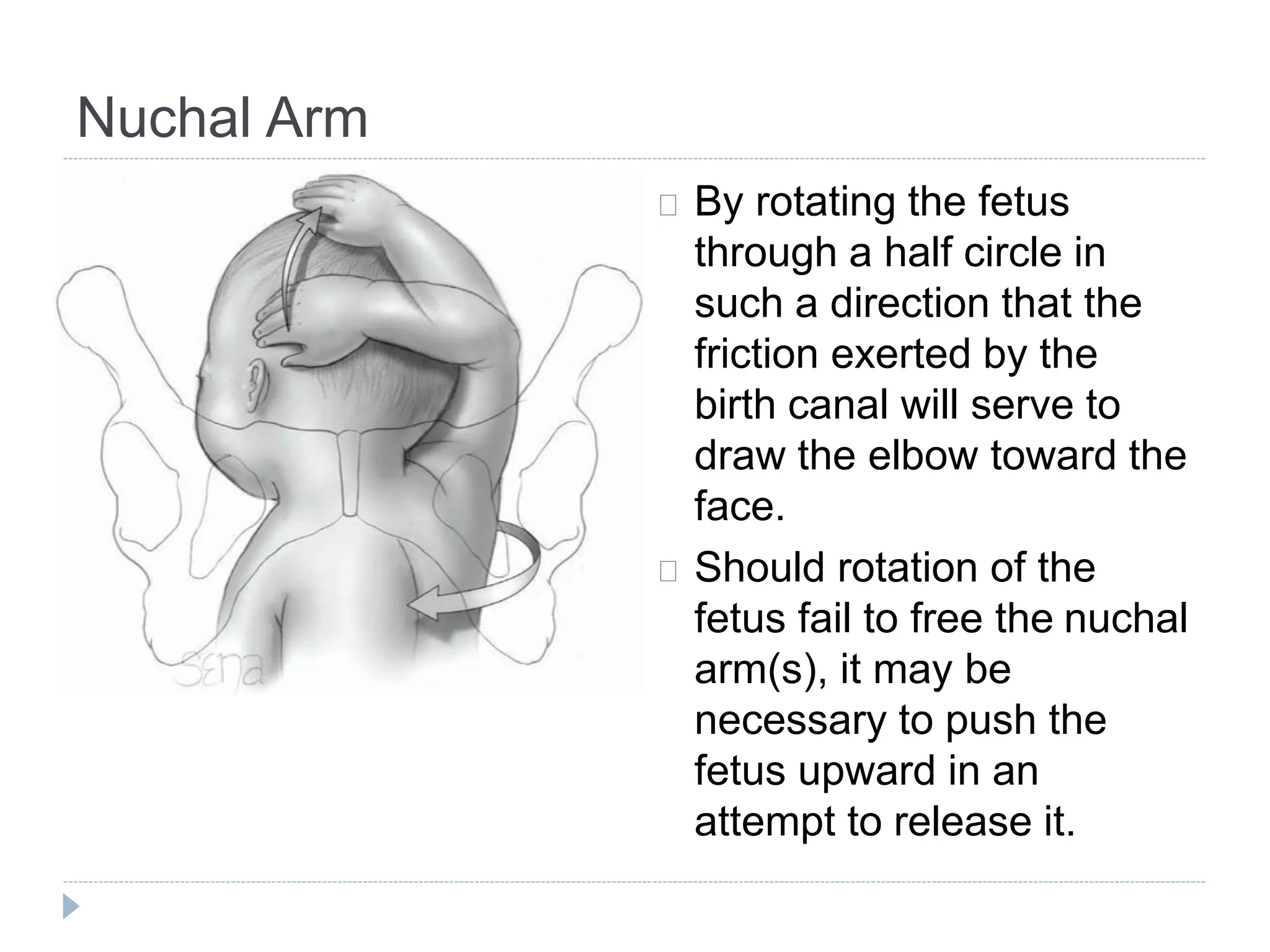 breech presentation.pptx