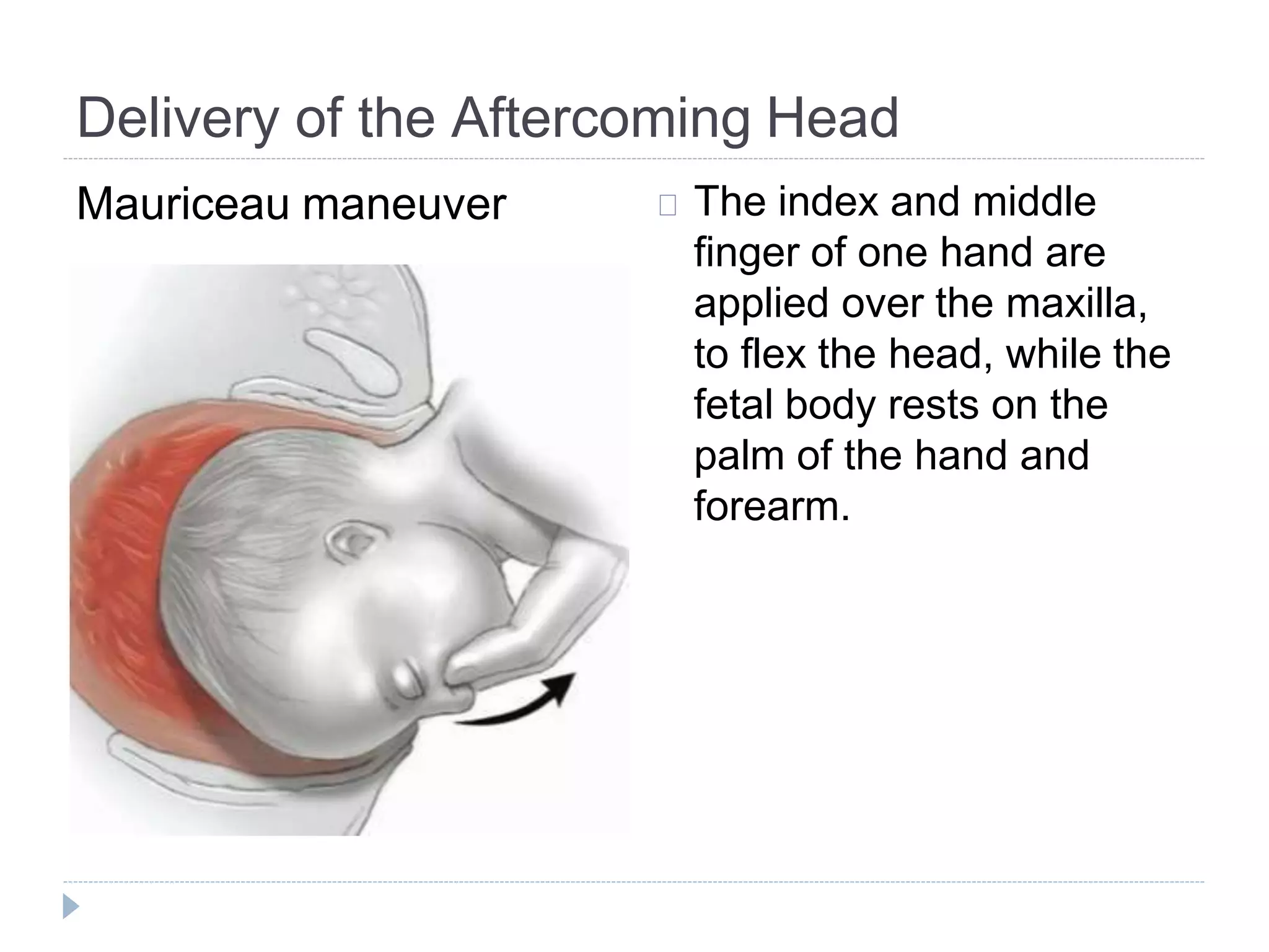 breech presentation.pptx