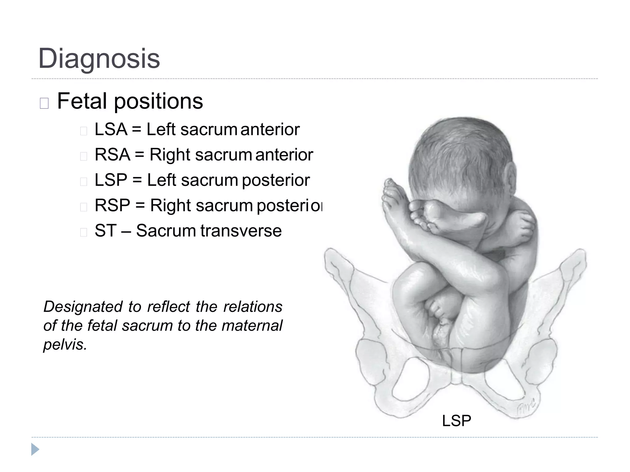 breech presentation.pptx