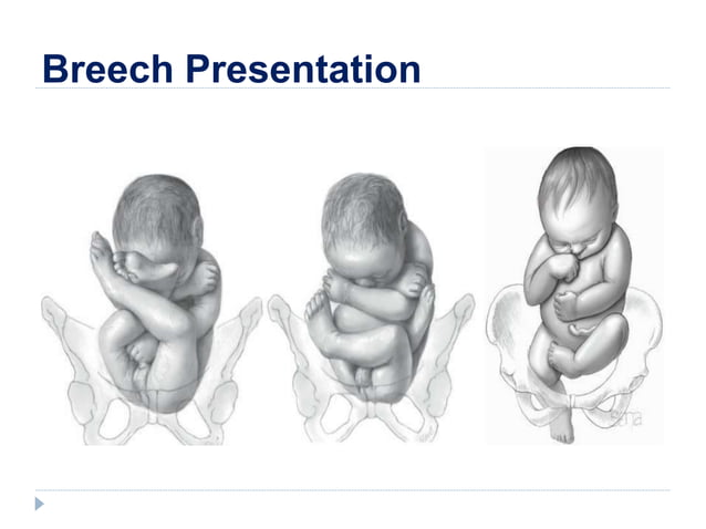 breech presentation.pptx | Pregnancy | Reproductive Health