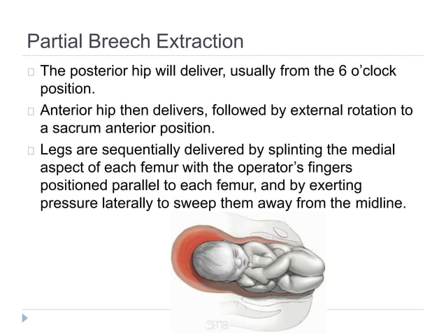 breech presentation.pptx | Pregnancy | Reproductive Health