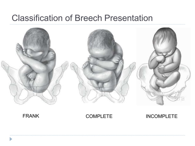 breech presentation.pptx | Pregnancy | Reproductive Health