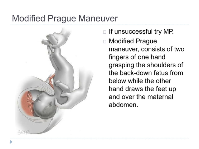 breech presentation.pptx | Pregnancy | Reproductive Health