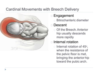 breech presentation.pptx