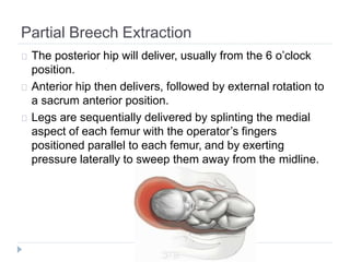 breech presentation.pptx